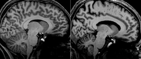 World’s strongest MRI investigates COVID and myalgic encephalomyelitis ...